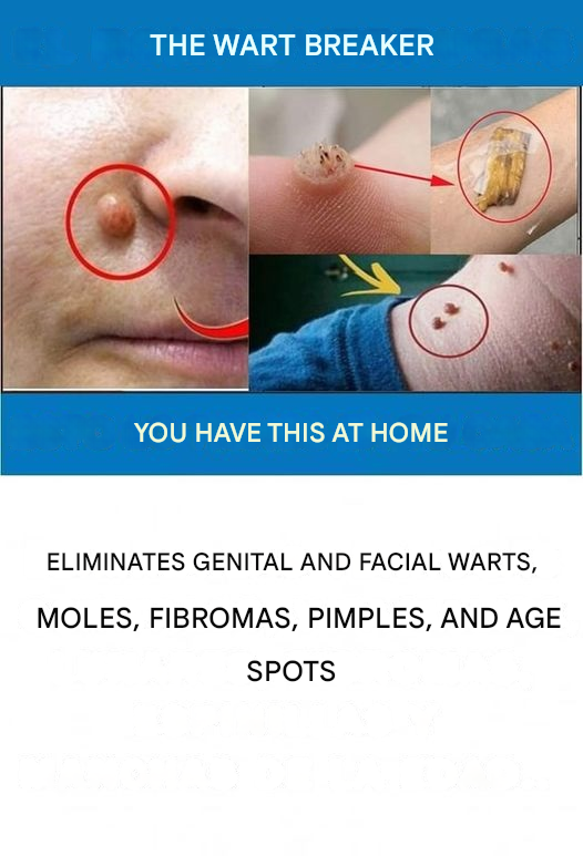 🧴 The Wart Breaker: You Probably Have This at Home—And It May Help with ...